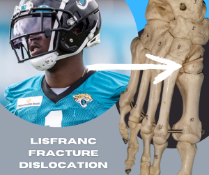 Lisfranc fracture dislocation | Bluegrass Foot Centers