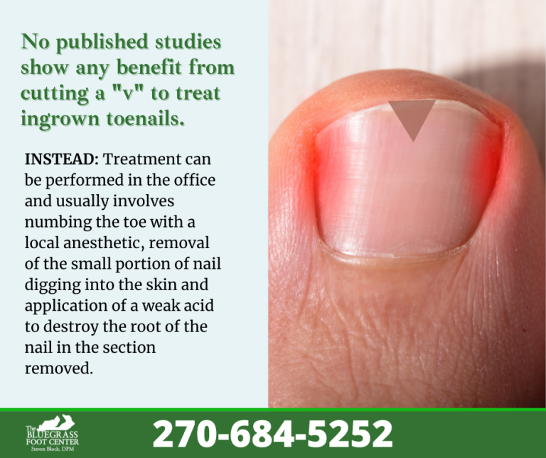 Ingrown Toenails | Bluegrass Foot Centers